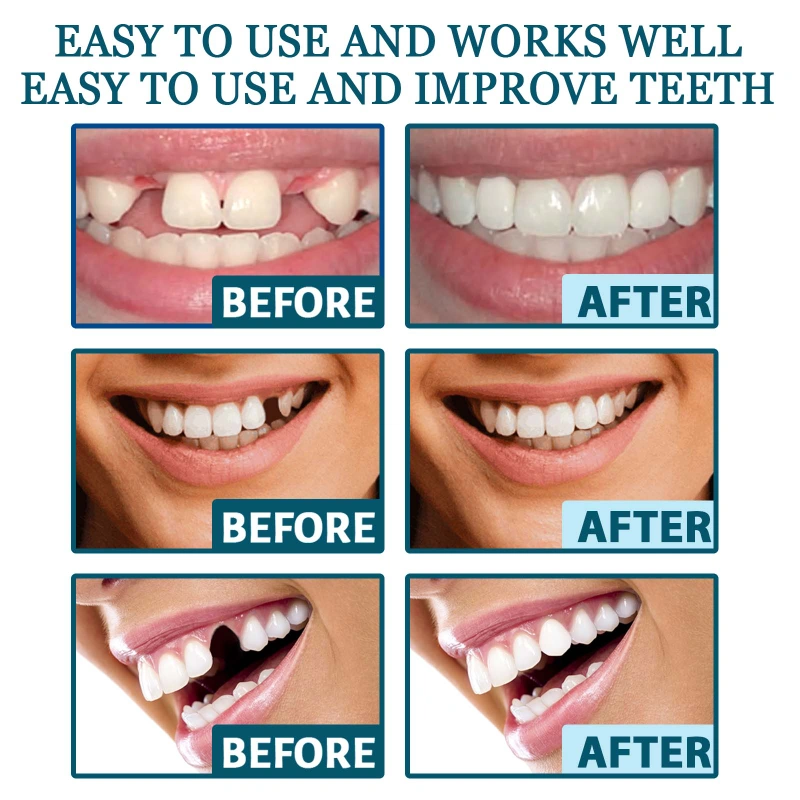 Fake tooth,EELHOE Adjustable Snap-on Dentures Temporary Teeth Repair ...