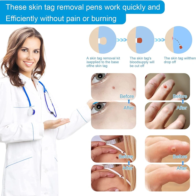Remove Skin Tag Pen,Remove Skin Tag Pen Facial Care Nevus Tool 1mm-8mm ...