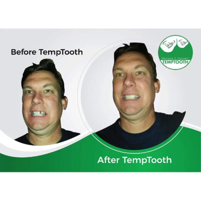 Temptooth Temporary Tooth Replacement Product With Dental Tools ...