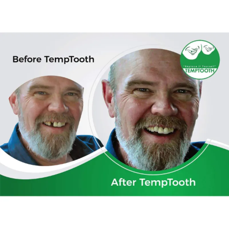 Temptooth Temporary Tooth Replacement Product With Dental Tools ...